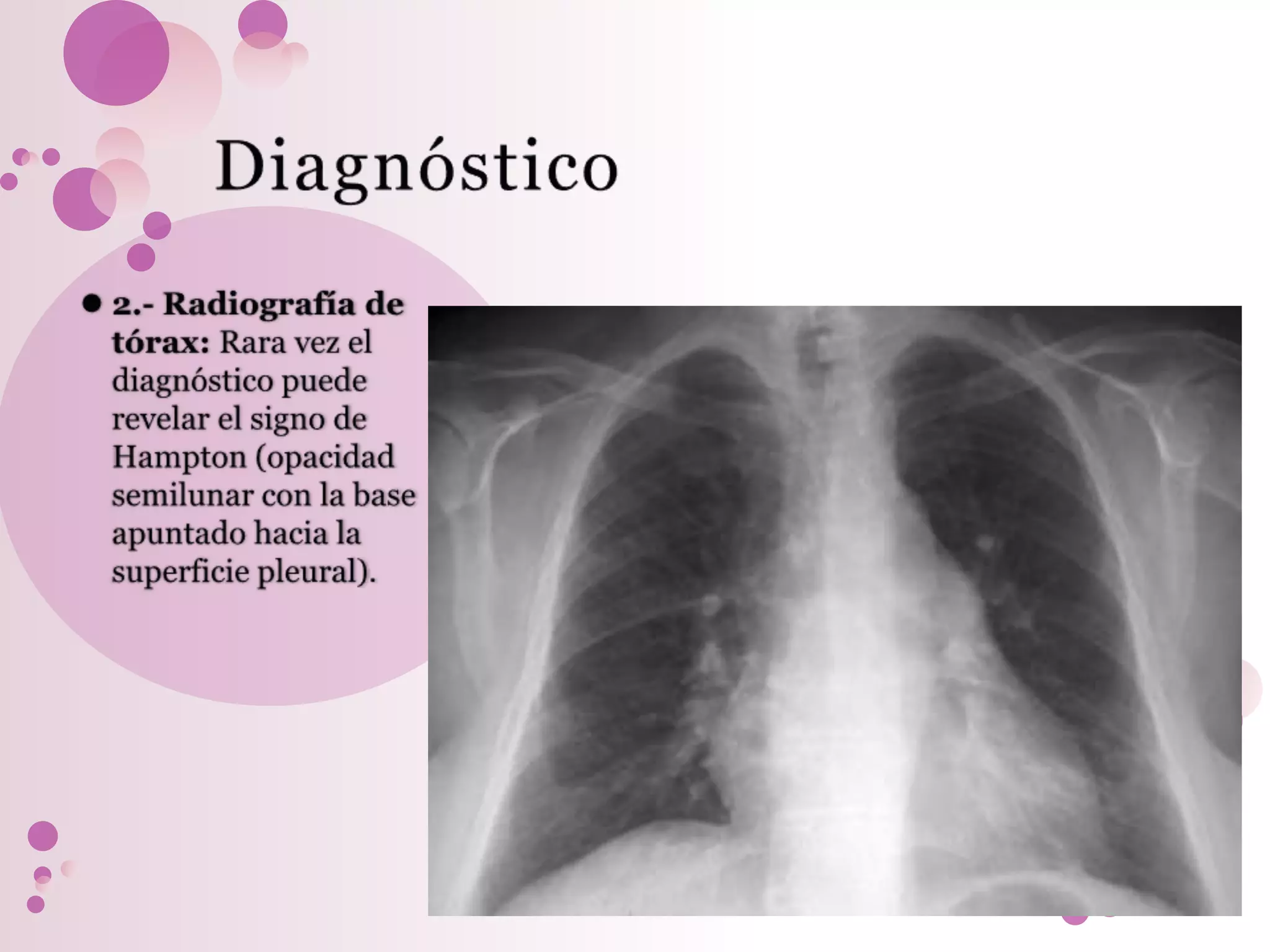 Tromboembolia pulmonar (tep) | PPTX