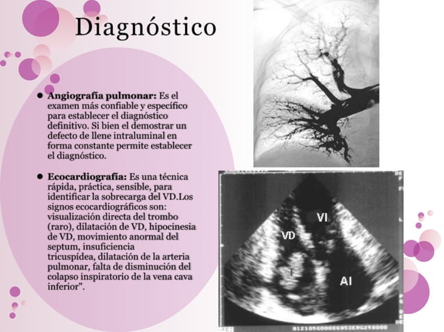 Tromboembolia pulmonar (tep) | PPTX