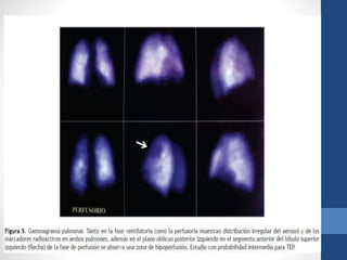 TROMBOEMBOLIA PULMONAR (TEP).pptx