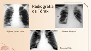 tromboembolia pulmonar TEP medicina interna | PDF