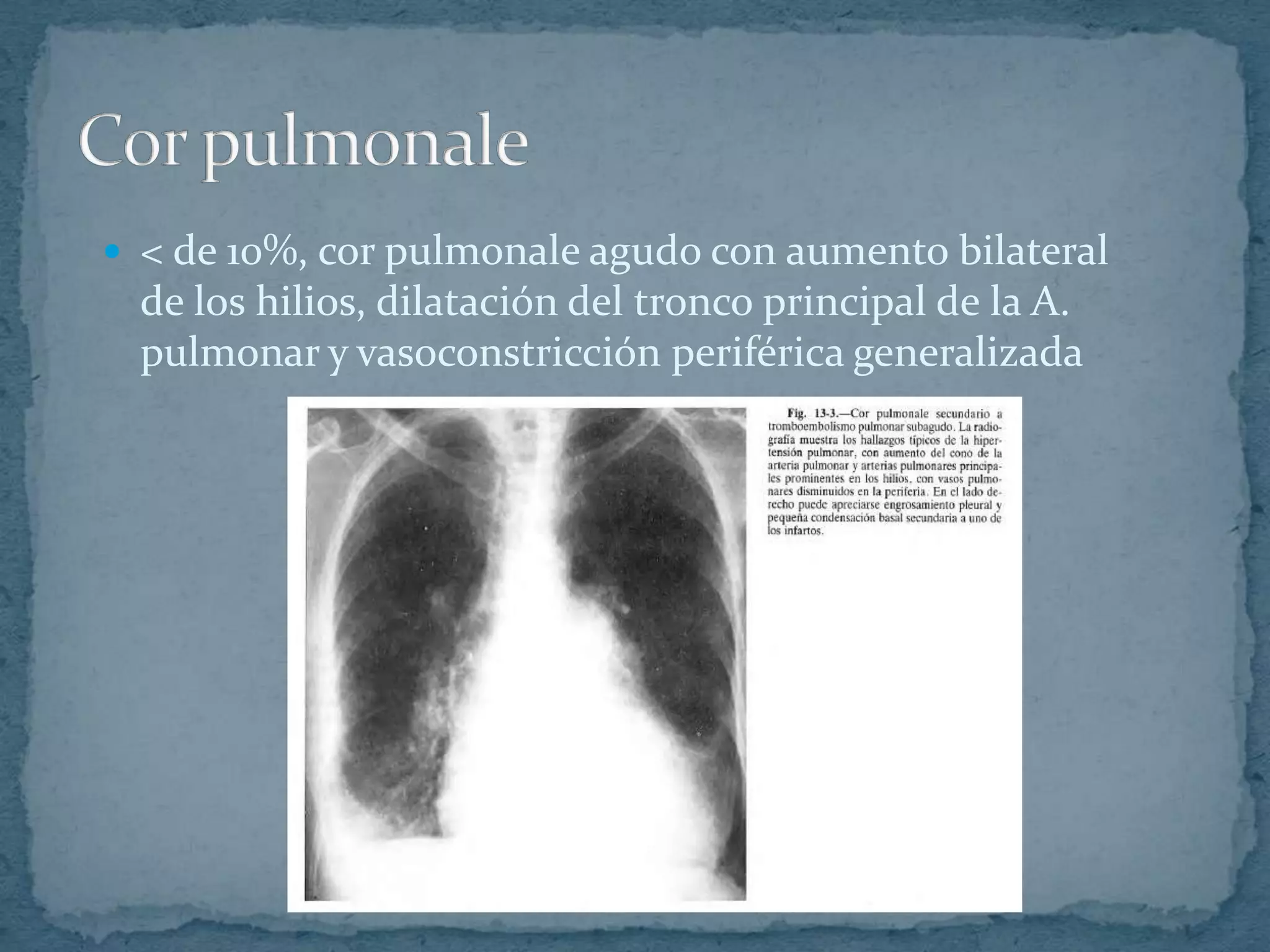 Radiografia y Tromboembolismo pulmonar | PPTX
