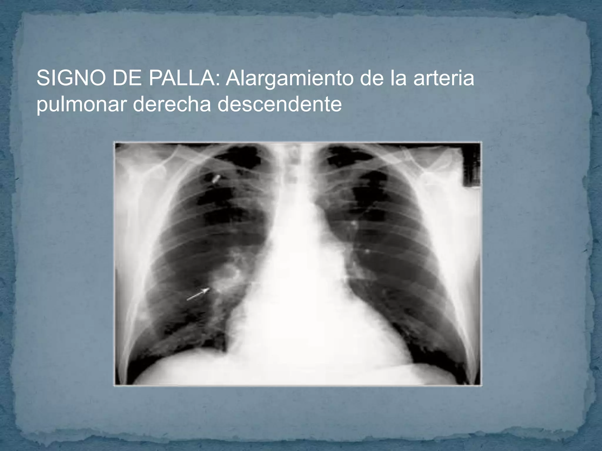 Radiografia y Tromboembolismo pulmonar
