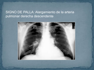 Radiografia y Tromboembolismo pulmonar | PPTX