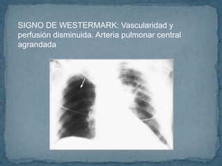 Radiografia y Tromboembolismo pulmonar | PPTX