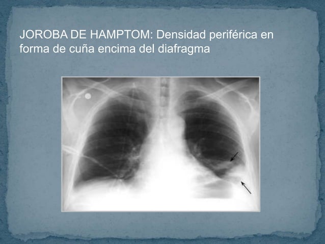 Radiografia y Tromboembolismo pulmonar