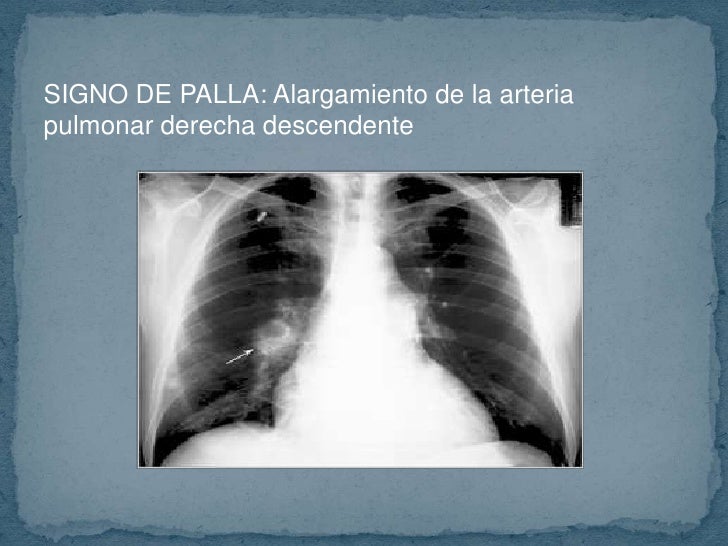Radiografia y Tromboembolismo pulmonar