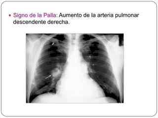 Tromboembolismo pulmonar | PPTX