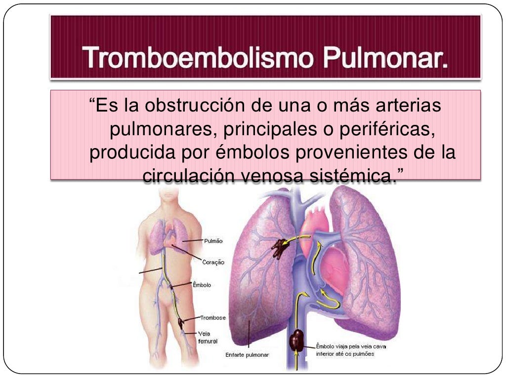 Cid 10 Tromboembolismo Pulmonar - RETOEDU