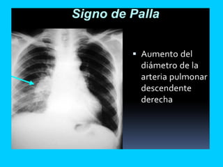 Tromboembolismo pulmonar | PPT
