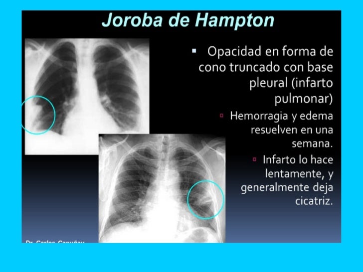 Tromboembolismo pulmonar