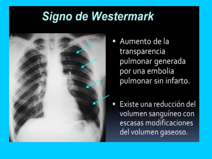 Tromboembolismo pulmonar