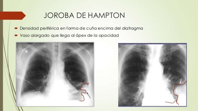 Tromboembolismo pulmonar