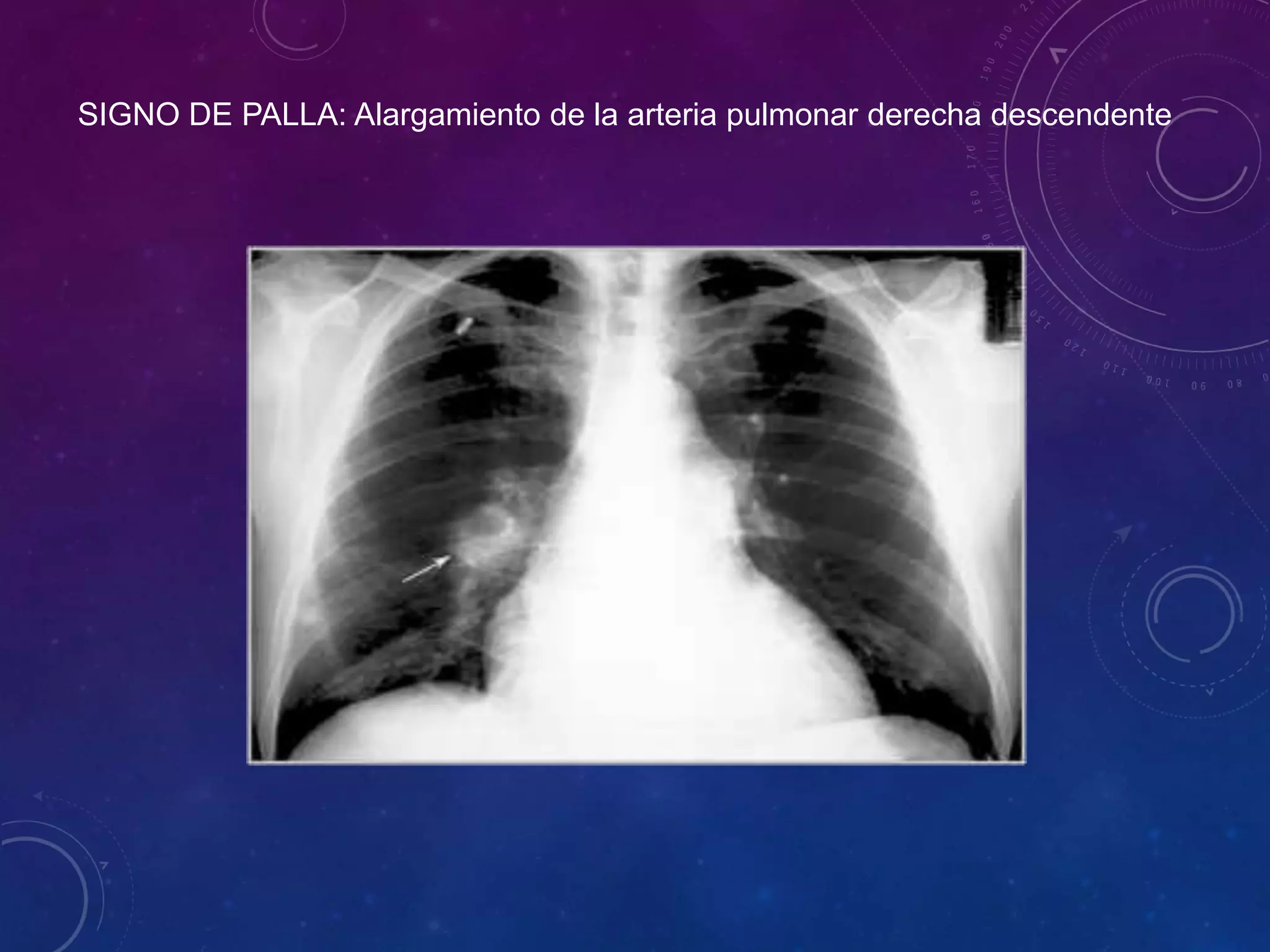 Diagnostico por Imagenes del Tromboembolismo Pulmonar | PPTX