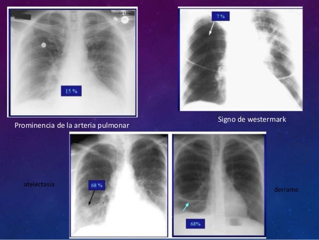 Diagnostico por Imagenes del Tromboembolismo Pulmonar