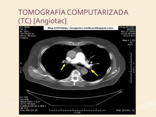 Trombo embolismo pulmonar | PPTX
