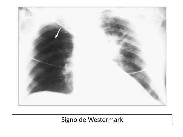 Tromboembolismo Pulmonar (TEP)
