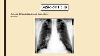 Tromboembolismo pulmonar | PPTX