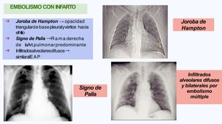 TROMBOEMBOLISMO PULMONAR.pdf