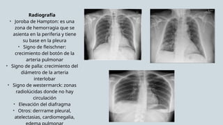 Cardiólogia clínica: tromboembolismo pulmonar | PPTX