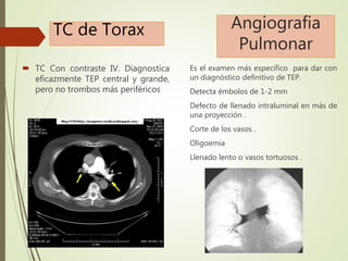 Tromboembolismo pulmonar TEP | PPTX