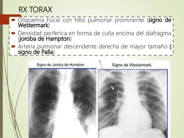 Tromboembolismo pulmonar TEP