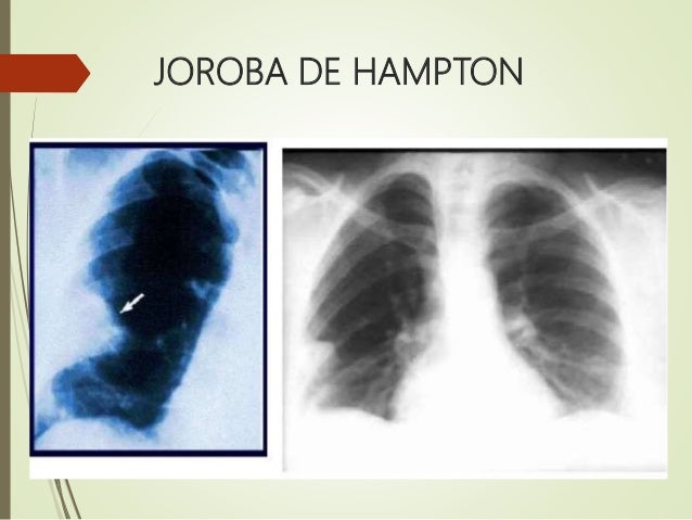Tromboembolismo pulmonar TEP
