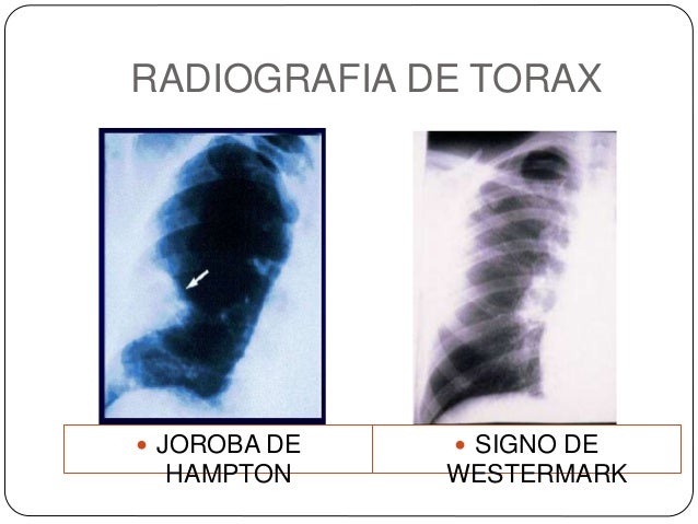 Tromboembolismo pulmonar