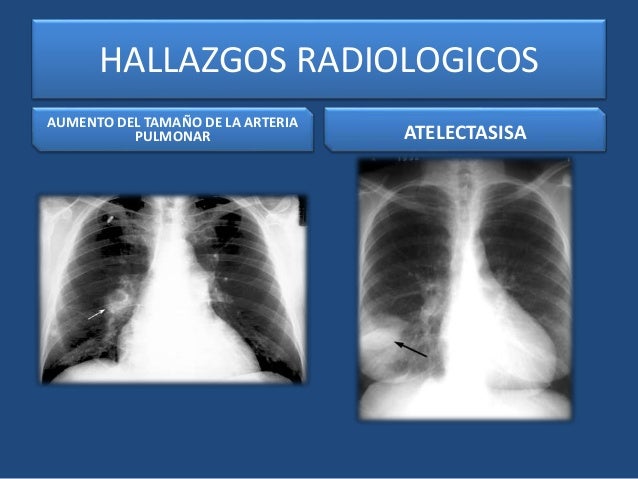 Tromboembolismo pulmonar