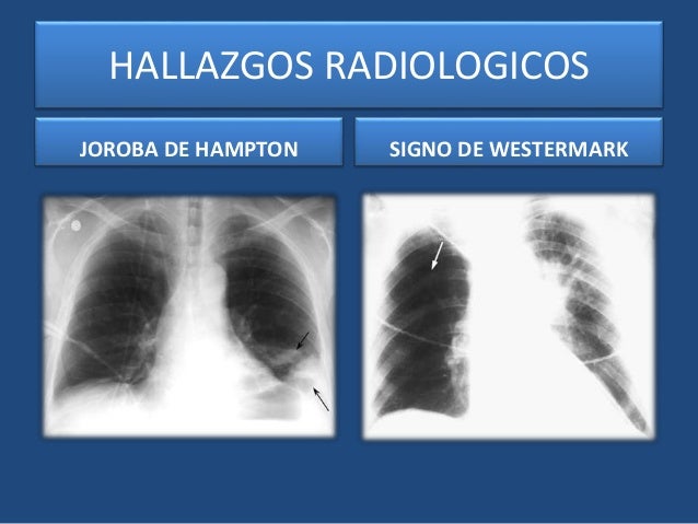 Tromboembolismo pulmonar