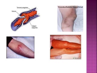 Tromboflebitis | PPTX
