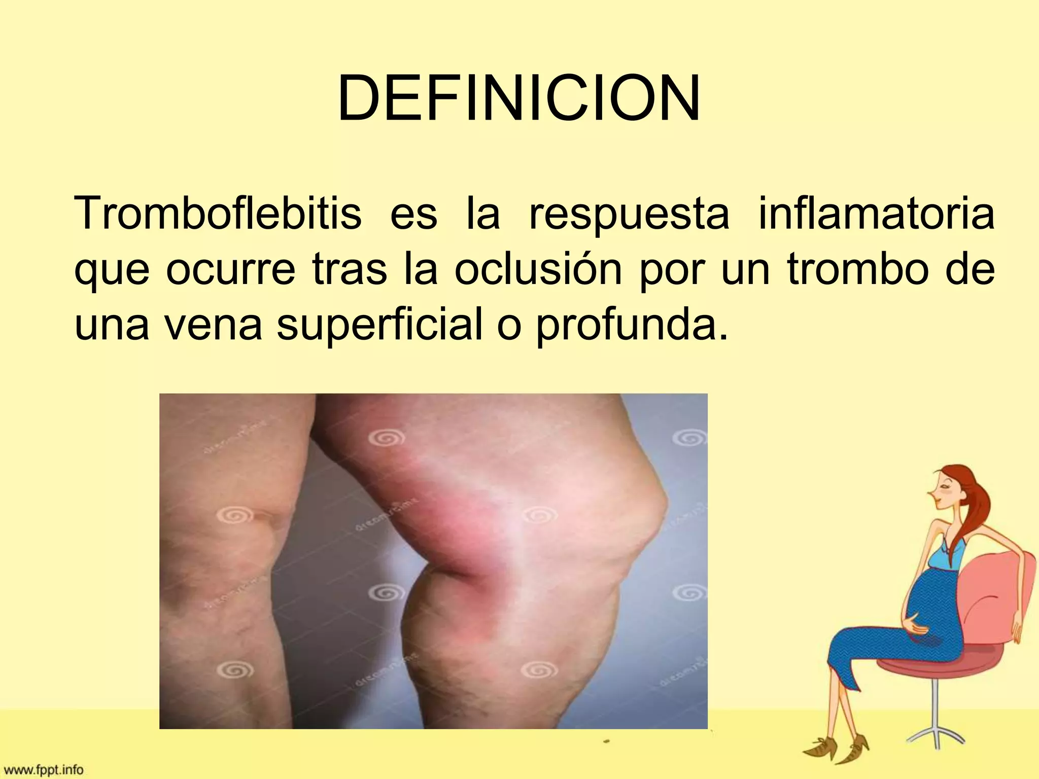 Tromboflebitis | PPTX