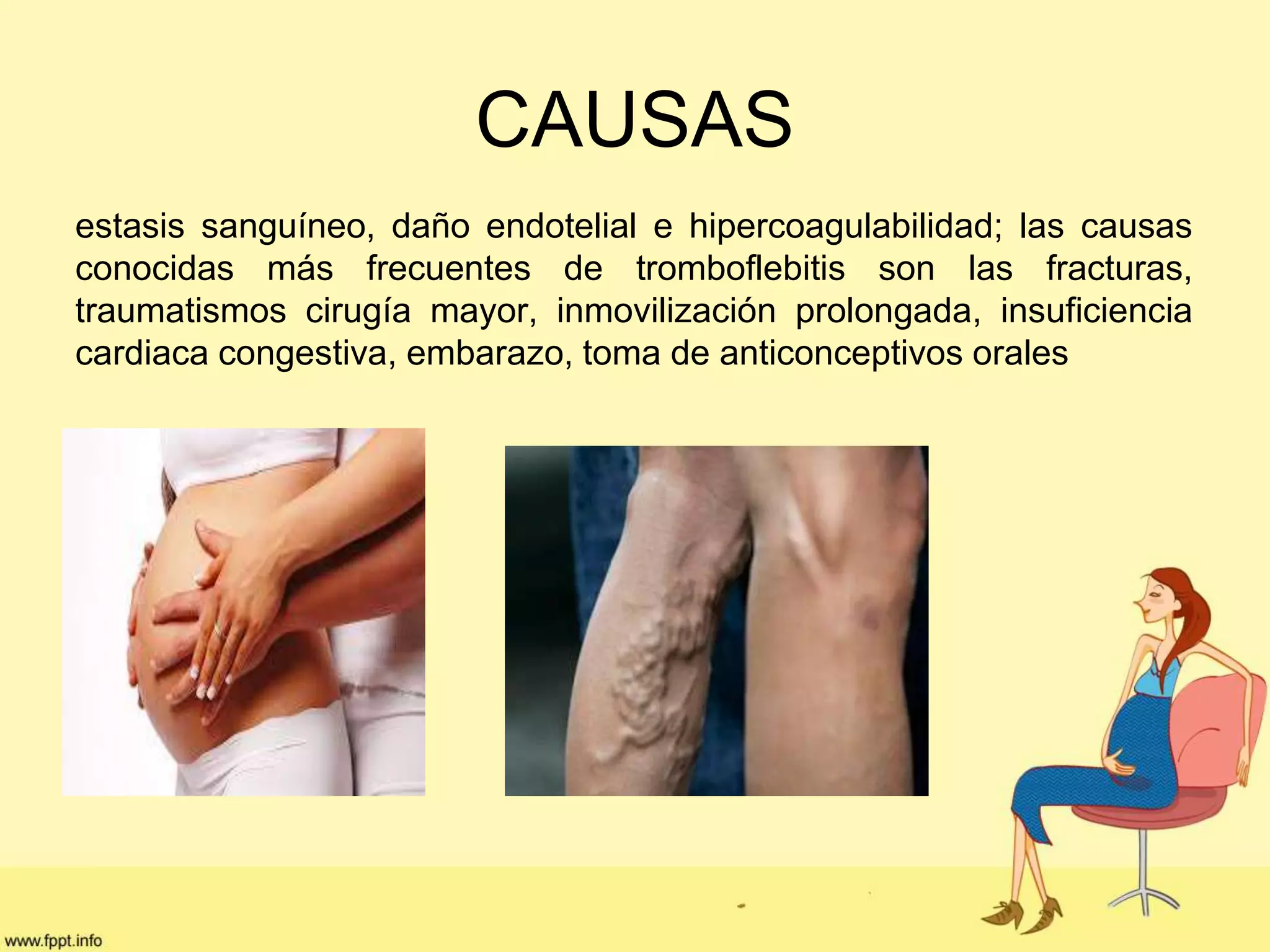 Tromboflebitis | PPT | Descarga Gratuita