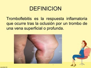 Tromboflebitis | PPTX