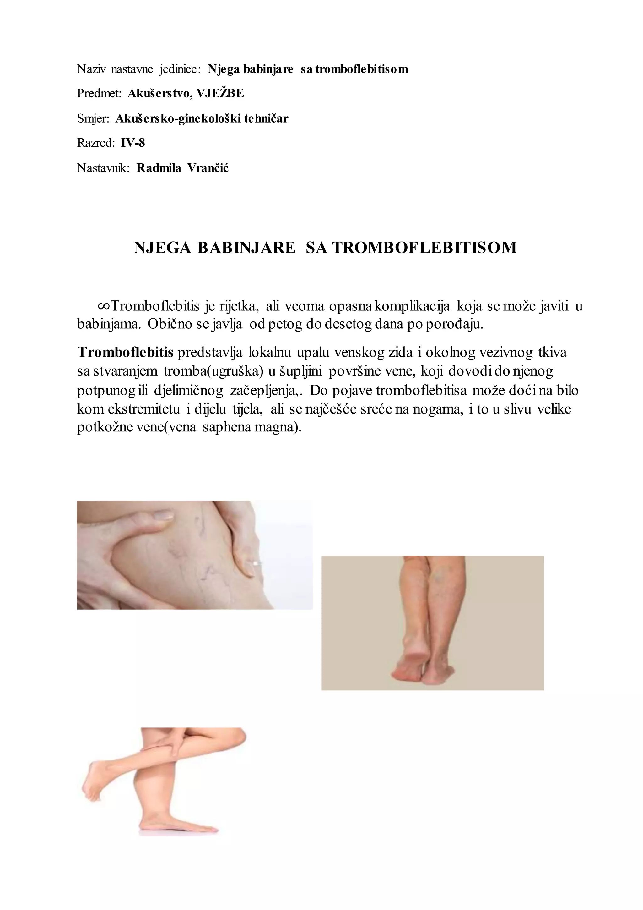 Tromboflebitis | DOCX