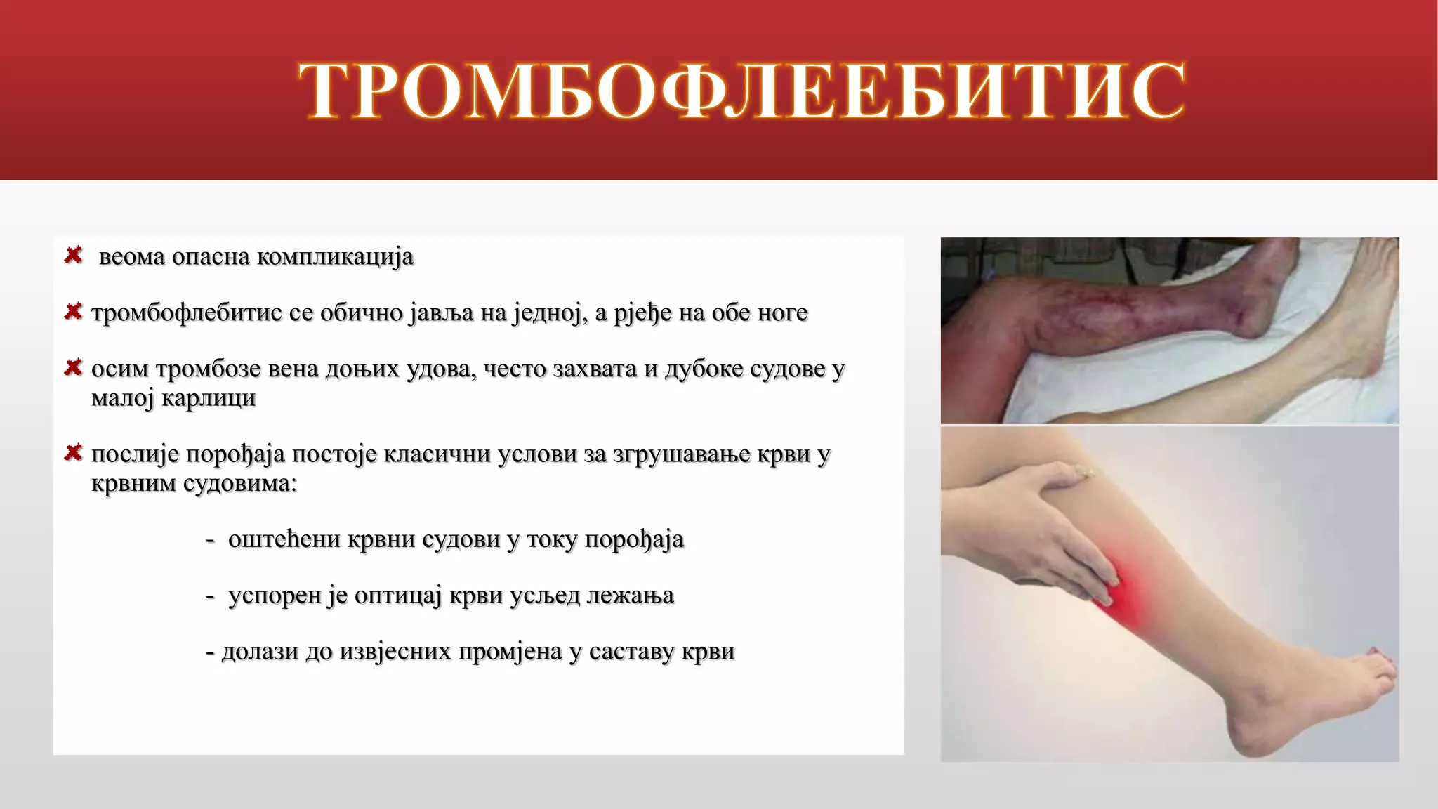 Tromboflebitis I Embolija Pptx