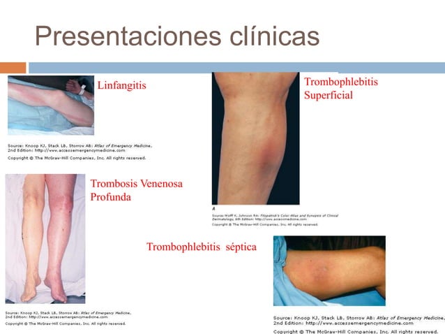 Tromboflebitis superficial | PPTX