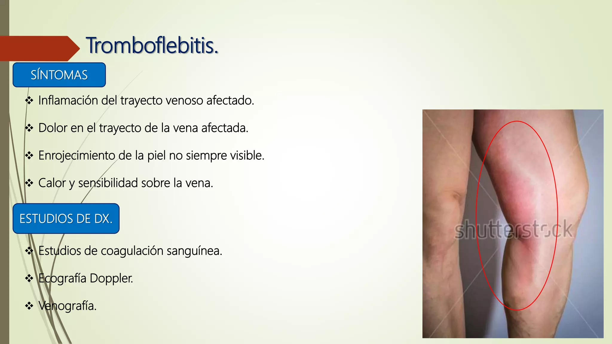 Tromboflebitis y flebotrombosis | PPTX
