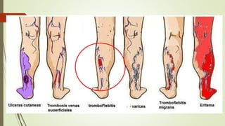 Tromboflebitis y flebotrombosis | PPTX