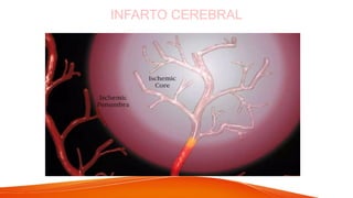 TROMBOLISIS EN ENFERMEDAD CEREBR VASCULAR ISQUEMICO.pptx