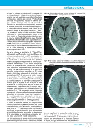 Primeros casos del manejo agudo con trombolisis endovenosa del ...