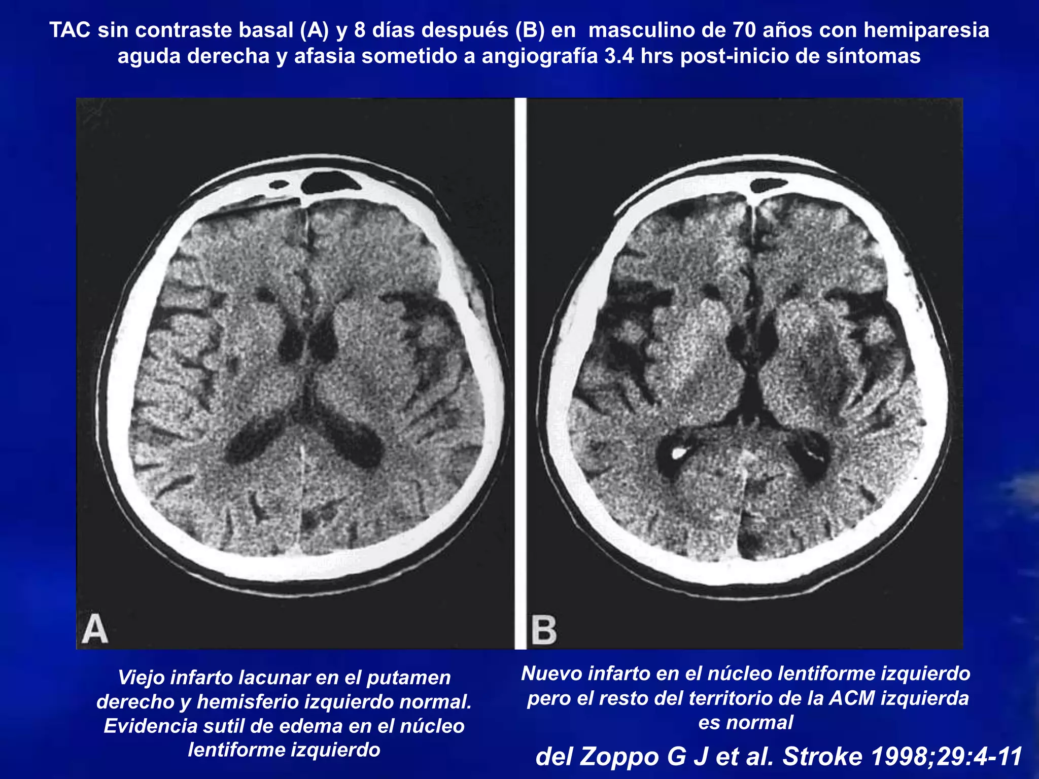 TROMBOLISIS INTRA-ARTERIAL EN EVENTO CEREBRAL VASCULAR ISQUEMICO AGUDO ...