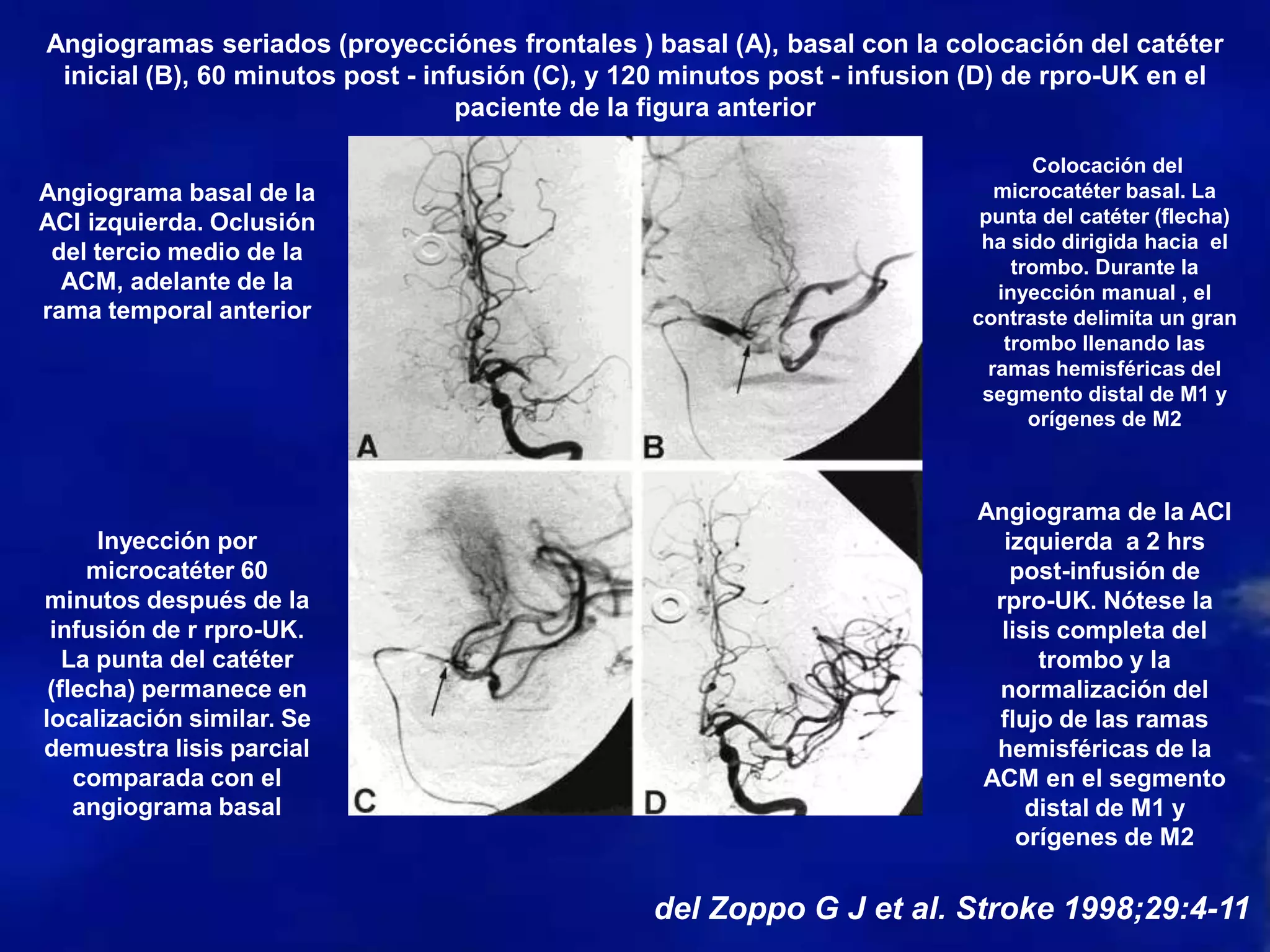 TROMBOLISIS INTRA-ARTERIAL EN EVENTO CEREBRAL VASCULAR ISQUEMICO AGUDO ...