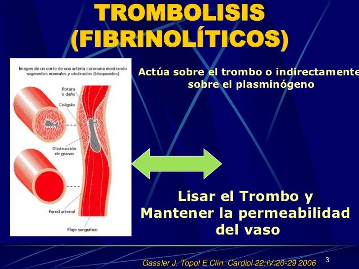 Trombolisis y angioplastia hesv