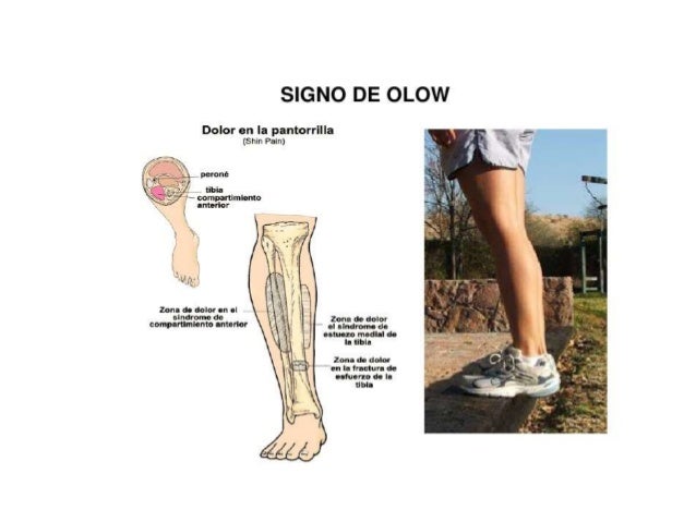 Trombosis venosa-profunda