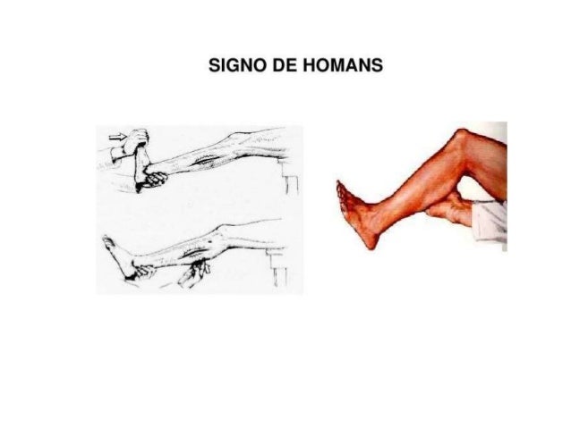 Trombosis venosa-profunda