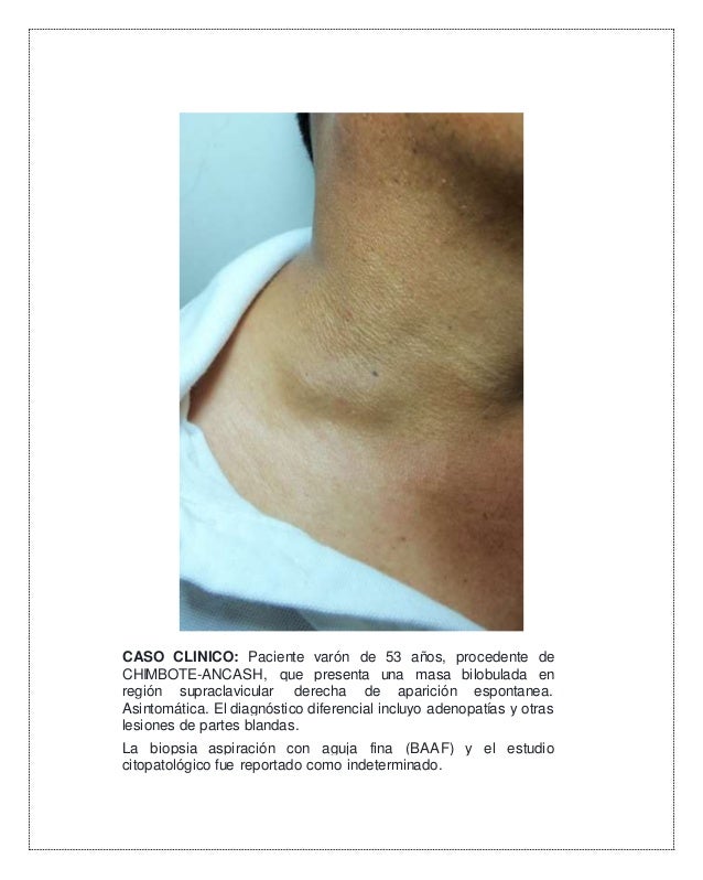 TROMBOSIS DE LA VENA YUGULAR EXTERNA