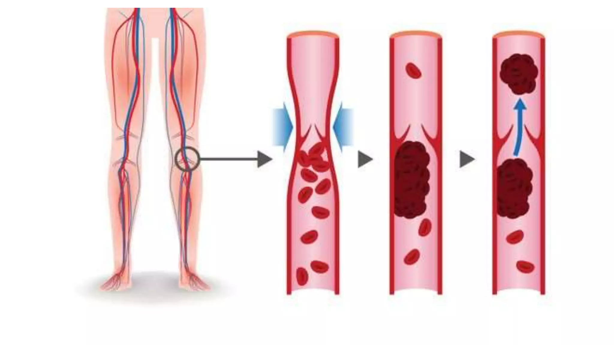 TROMBOSIS VENA DALAM DAN VARISES VENA DALAM.pptx | Blood Disorders ...