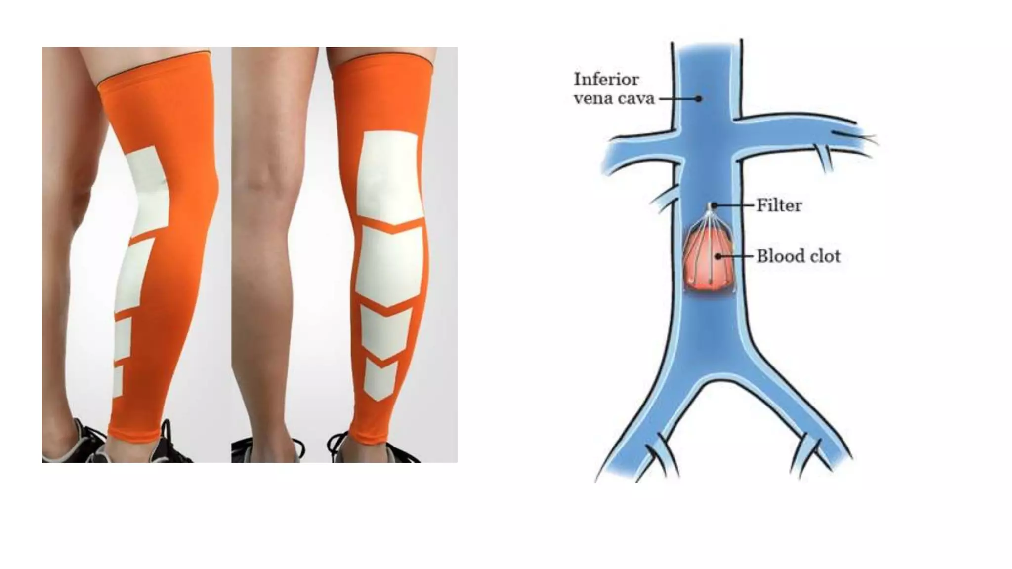 TROMBOSIS VENA DALAM DAN VARISES VENA DALAM.pptx | Blood Disorders ...