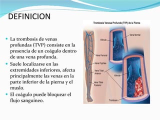 Trombosis venosa | PPT