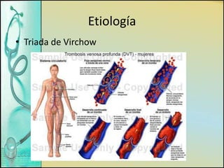 Trombosis venosa profunda | PPTX